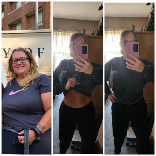 SIPS/SADI/LDS Versus Sleeve--What's the Difference | Find Surgical ...