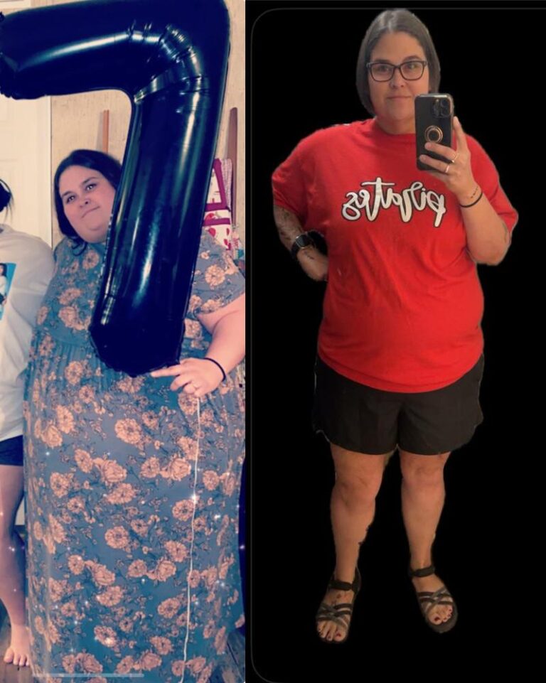 Blue Cross Blue Shield Weight Loss Surgery Coverage 2024 Explained